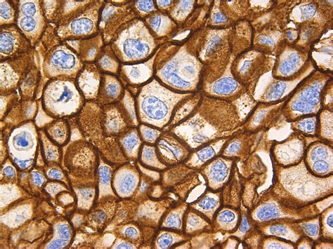 Jerad Gardner Md On Twitter Rt Patholwalker Salivary Duct