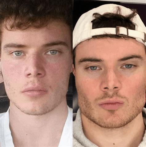 10 Chewing Gum Jawline Before And After Pictures WOW Vlr Eng Br