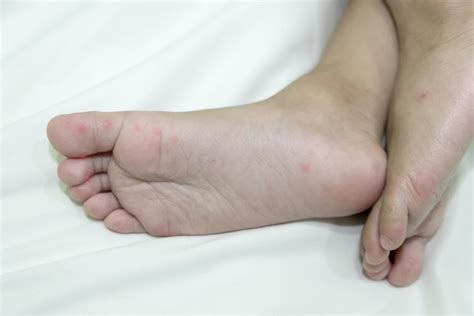 Puntos rojos en la planta del pie Causas y tratamiento Belleza estética