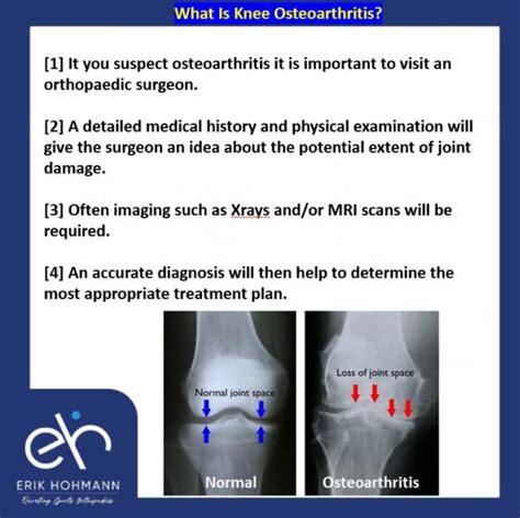 What Is Knee Osteoarthritis Dr Erik Hohmann