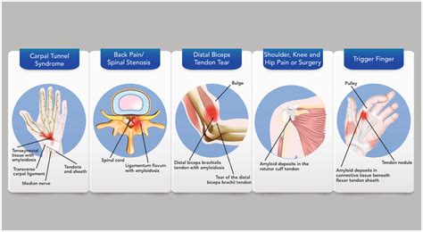 Musculoskeletal Manifestations Associated With ATTR Amyloidosis