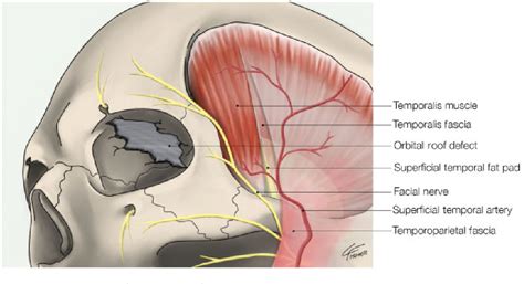 Figure 1 From Orbital Skull Base Reconstruction With Temporalis Muscle