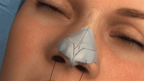 Rinoplastia Precio Franc S Cirug A Est Tica De Nariz Programaci N