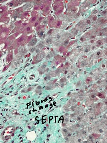 Liver Pathology Flashcards Quizlet