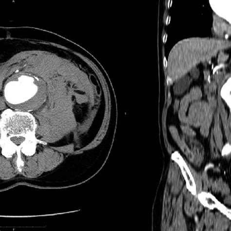 Preoperative Computed Tomography The Infrarenal Abdominal Aortic