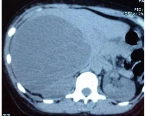 tomodensitométrie TDM abdominale dévaluation objectivant une
