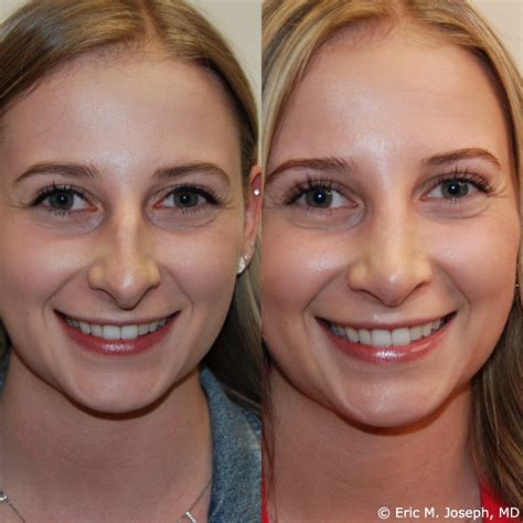 Eric M Joseph MD Rhinoplasty Before After Hump Removal And Tip