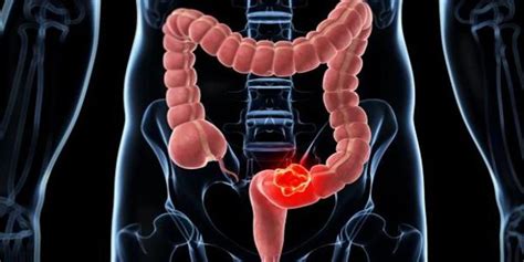 Que Es El Cancer De Colon