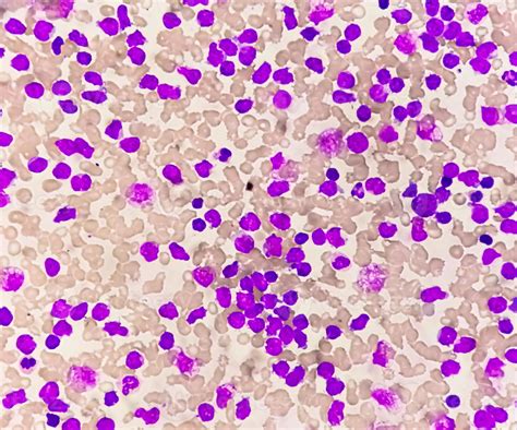 Blood Smear Under Microscopy Showing Chronic Lymphoblastic Leukemia Or