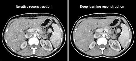 deep learning reconstruction of ct images phantomx