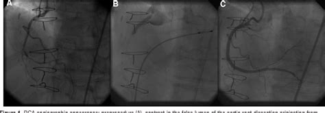 Figure From Resolution Of Iatrogenic Aortic Dissection Illustrated By