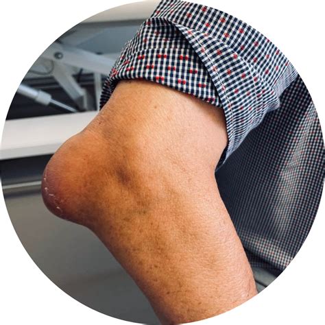 Schleimbeutelentzündung Bursitis olecrani Gelenkzentrum Zürich