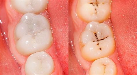 Dente Cárie Profunda Consulta Ideal