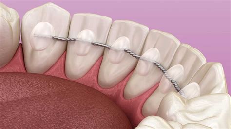 Retainer For Teeth Before And After