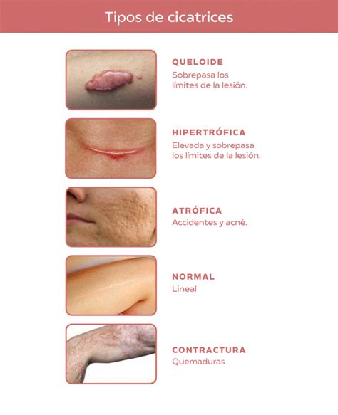 Diferencias Entre Cicatrices Queloides E Hipertróficas Omicroart