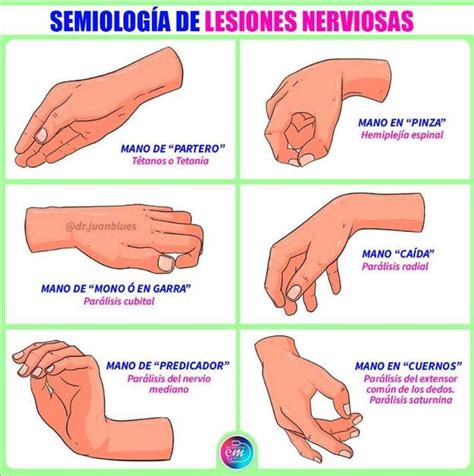 Semiolog A De Lesiones Nerviosas Yudoc Org Udocz