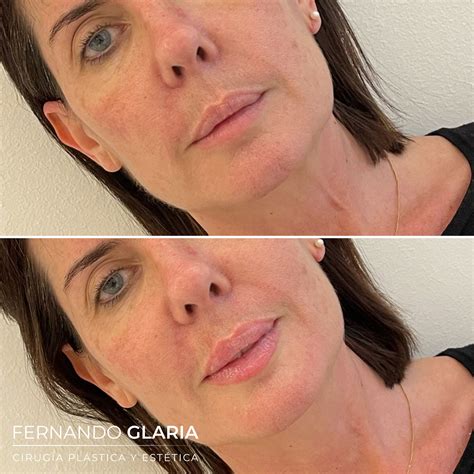 Antes y después Esteticas ar Esteticas ar