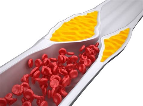 12 alimentos para desobstruir veias e artérias