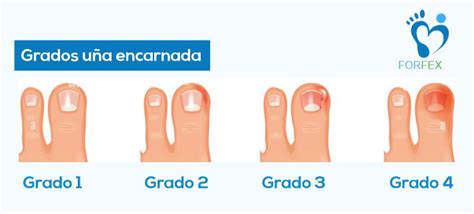 Tratamiento Uñas Encarnadas Podología Bogotá Norte