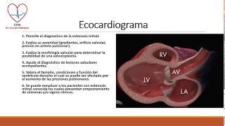 Fisiopatología De La Estenosis De La Válvula Mitral