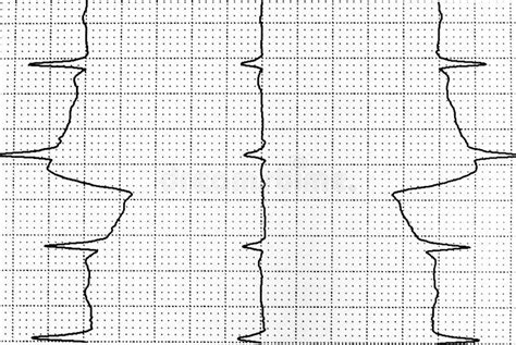Prueba Del Electrocardiograma Que Muestra La Actividad Eléctrica Del