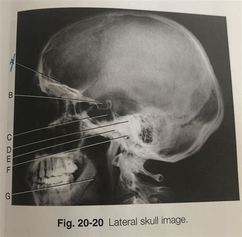 Lateral Skull Diagram Quizlet