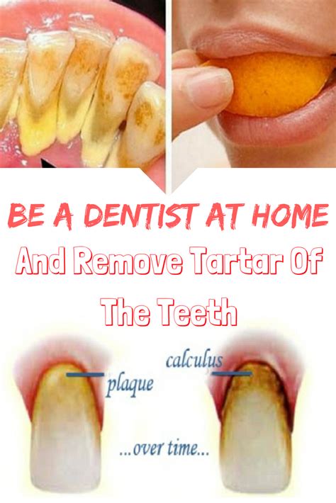 48 How To Remove Tartar From Teeth At Home Ideas In 2021