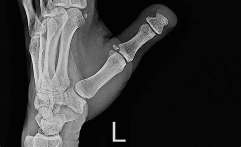 Ulnar Collateral Ligament Avulsion Fracture Hot Sex Picture