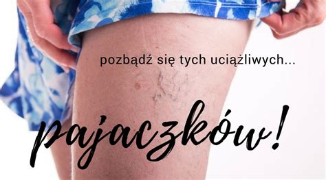 Witniczanka pl czyli mój punkt widzenia Metody na popękane naczynka
