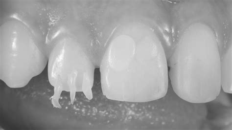 Reabilitação estética anterior do clareamento à reconstrução