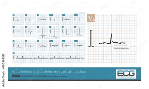 Distal Occlusion Of The Right Coronary Artery Can Cause Inferior And