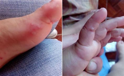 Coxsackie Cuáles son los síntomas del virus que mantiene en alerta a