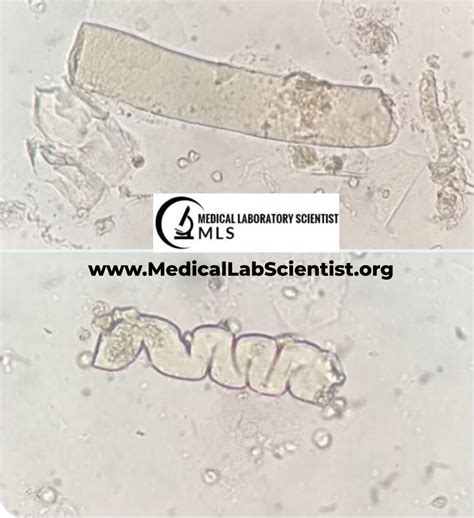 Urinary Casts Types Composition Significance Causes Diagnosis