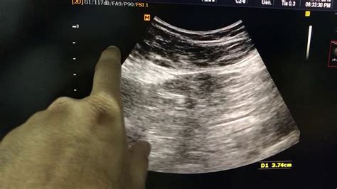 Incisional Hernia Ultrasound Youtube