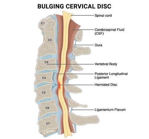 What Is The Difference Between Bulging Disc And Herniated Disc All