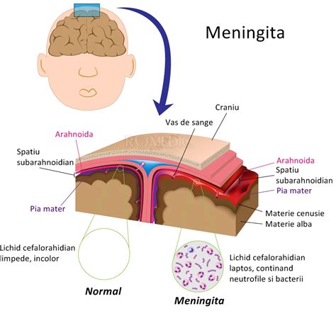 Meningita