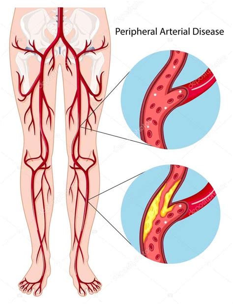 Claudication Peripheral Arterial Disease Coastal Vascular Center