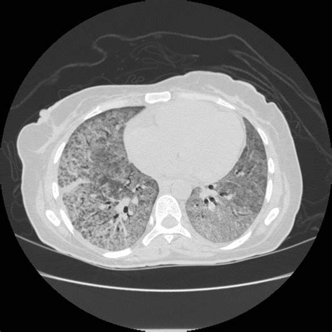 Radiopaedia Case Pneumocystis Jirovecii Pneumonia Id 29434 Study