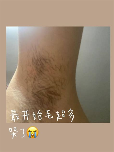 你们有那种一个毛孔长三根毛的经历么？！我本人 知乎