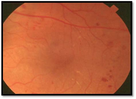 Lecture Ocular Side Effects Of Systemic Drugs Flashcards Quizlet