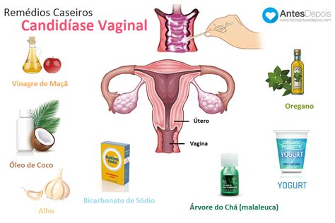 10 Remédios Caseiros para Candidíase Vaginal Educar Saúde