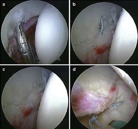 Hip Labral Reconstruction Surgery
