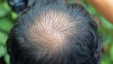 Todo sobre la alopecia difusa causas y cómo tratarla