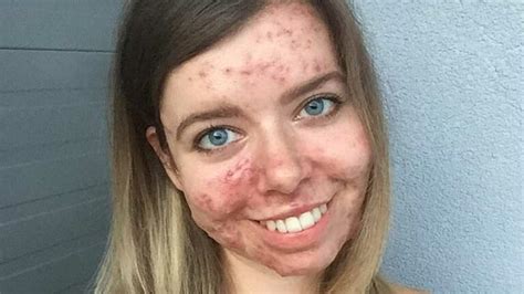 Pour donner du courage aux femmes elle dévoile son visage touché par l