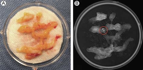 Stereotactic Breast Biopsy Pitfalls And Pearls Techniques In