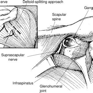 Posterior Approach To The Suprascapular Nerve At The Spinoglenoid Notch