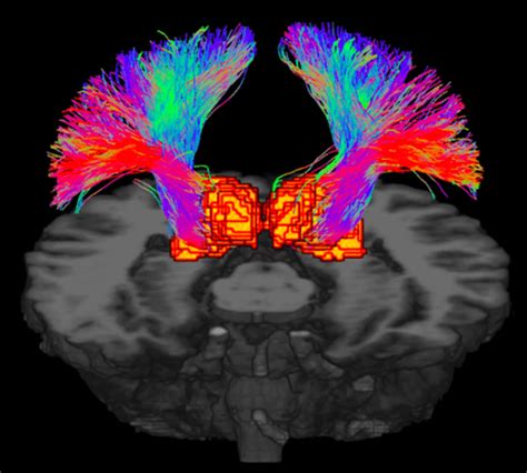 diffusion tensor imaging archives neurosurgery blog