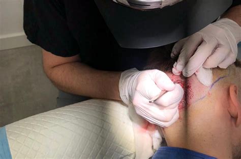 4 etapy przeszczepu włosów metodą FUE Kierach Medical Clinic