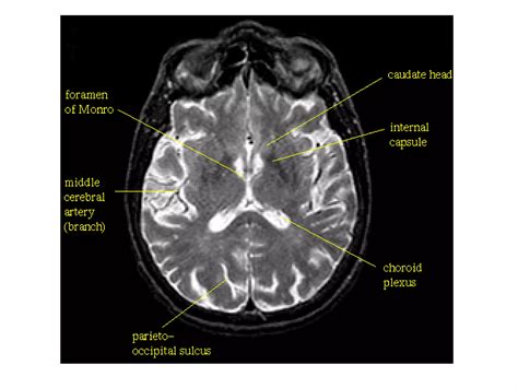 Diagnostic Imaging Of Hydrocephalus Pneumocephalus PPT
