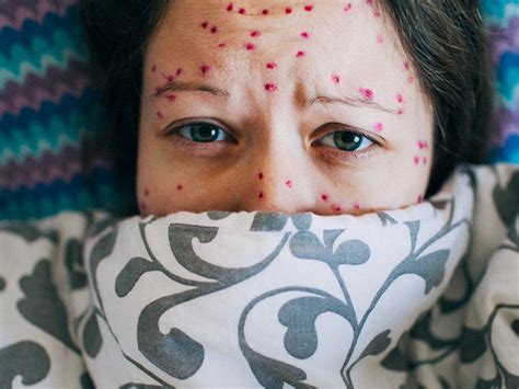 Can You Get Shingles If You Never Had Chickenpox